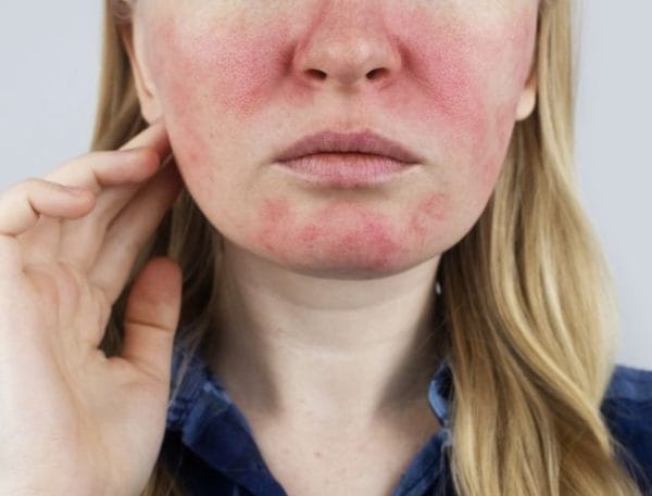 Redness on Face: Common Causes and How to Treat It