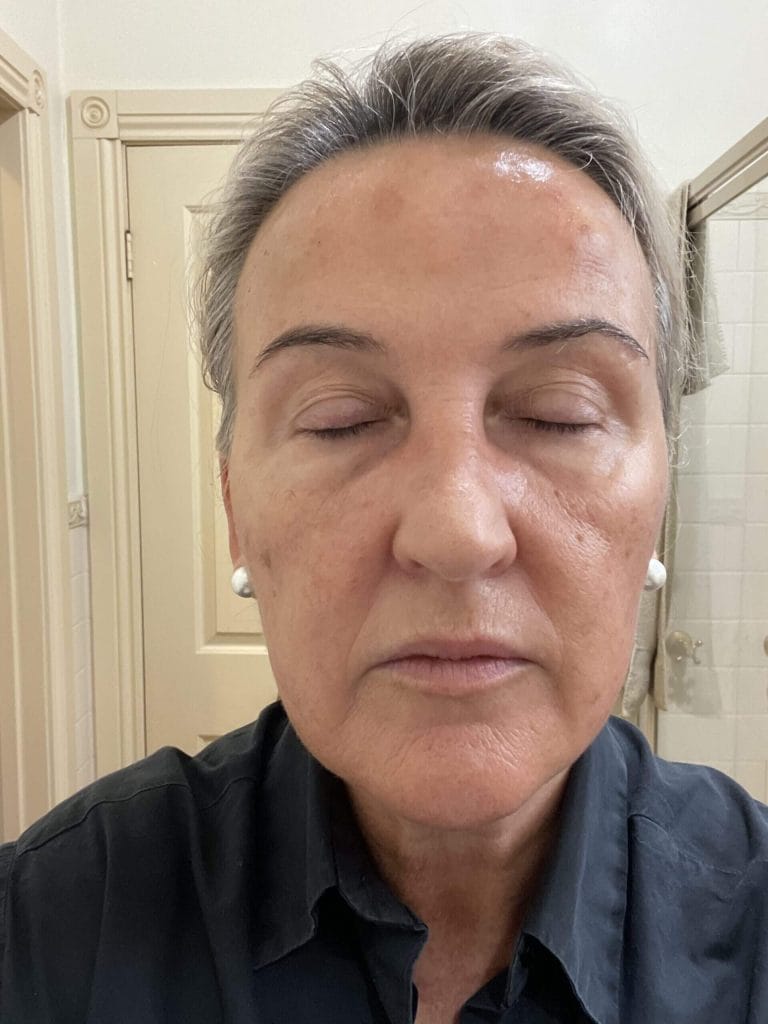 Hyperpigmentation vs Hypopigmentation Explained - U SKIN Clinics