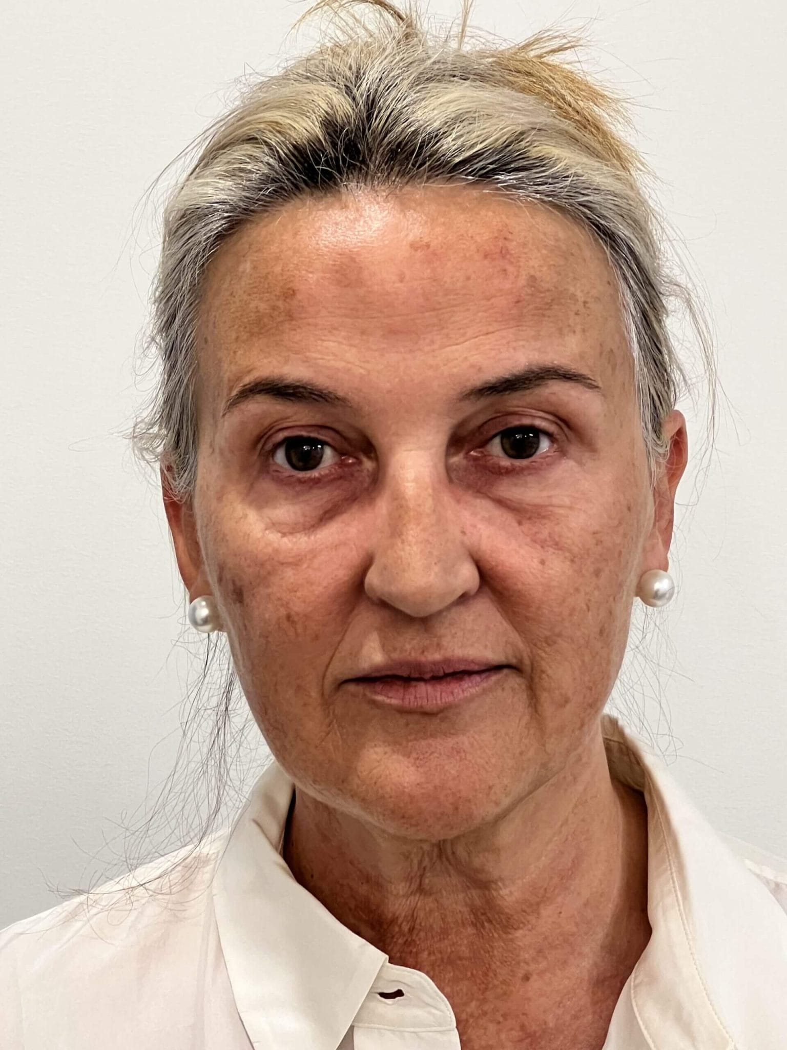 Hyperpigmentation vs Hypopigmentation Explained - U SKIN Clinics